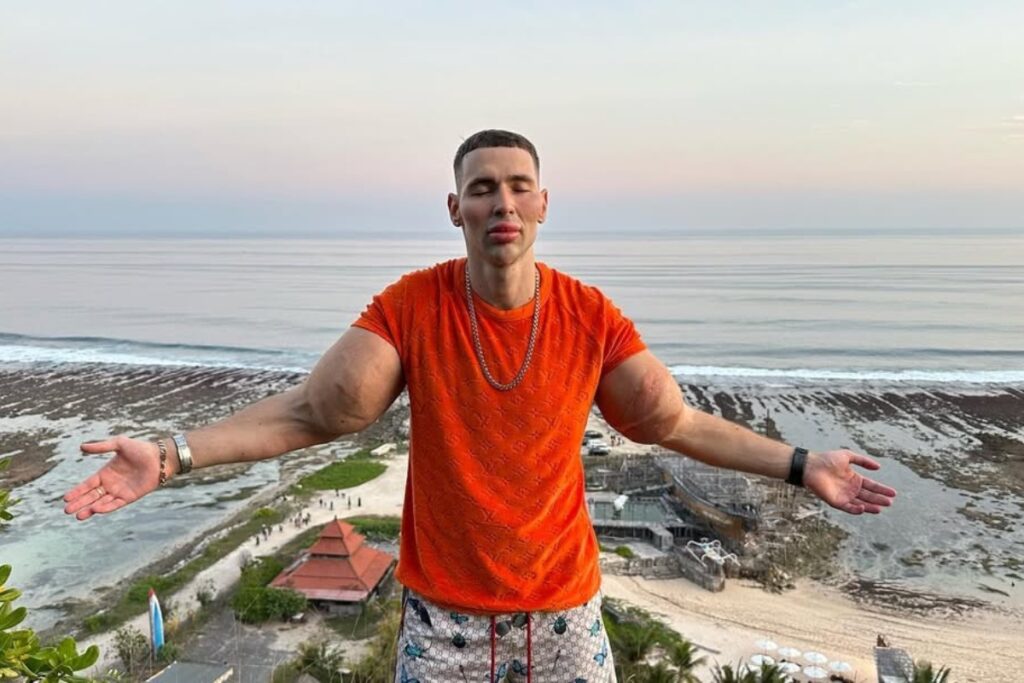 El 'Popeye ruso', que se inyectó Synthol para agrandar sus bíceps ...